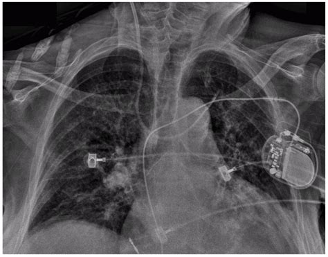 Left Subclavian Vein Central Line