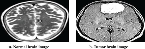 Brain Tumor Classification Based On Improved Stacked Ensemble Deep Learning Methods Pmc
