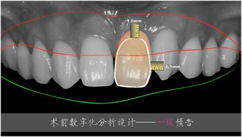 牙齿高度和宽度 标准牙齿宽度示意图 每个牙齿的宽度是多少 第3页 大山谷图库