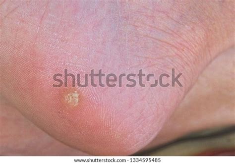 Plantar Wart On Heel Female库存照片1334595485 Shutterstock