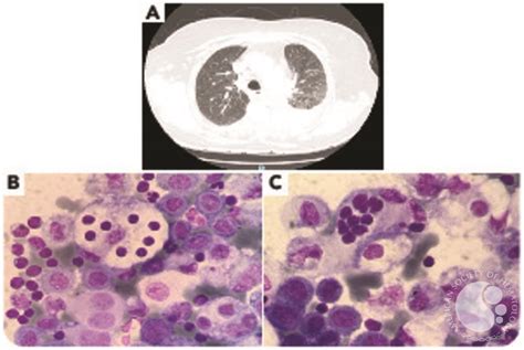 Unusual Histiocytes In A Pleural Effusion Signature Of A Rare Disease