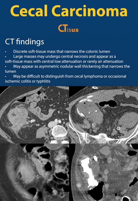 Cecal Carcinoma Ct Findings Ctisus
