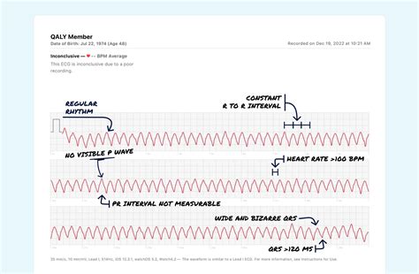 Sinus Tachycardia Vs Ventricular Tachycardia Sustained On Your Watch ECG Qaly