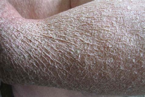 50 Facts About Ichthyosis Vulgaris