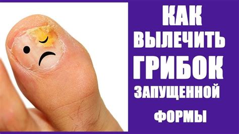 как вылечить грибок ногтей ног Uniformcustomize