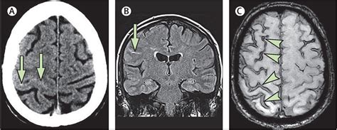 Intracerebral Hemorrhage Vs Subarachnoid Hemorrhage