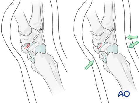 Nonoperative Treatment For Scaphoid Tubercle Fracture