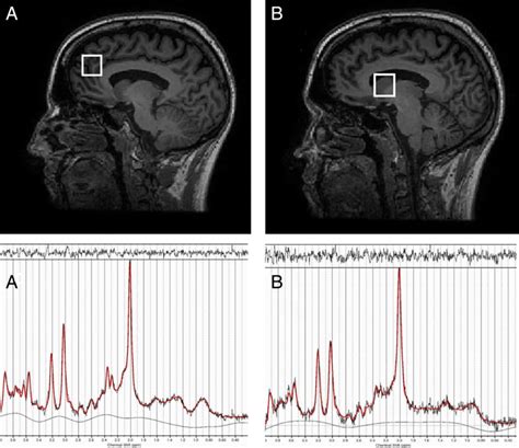 ¹h mrs voxel positioning and example spectra in the anterior cingulate