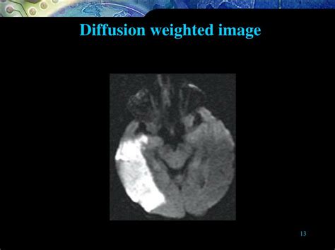 Ppt Diffusion And Perfusion Mri Imaging Powerpoint Presentation Id448079
