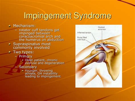 Shoulder Impingement Syndrome