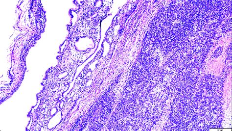 On The Right Side Sex Cord Stromal Tumor With Equal Numbers Of
