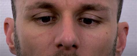 Trochlear Nerve Cranial Nerve Iv Cn Iv Assessment