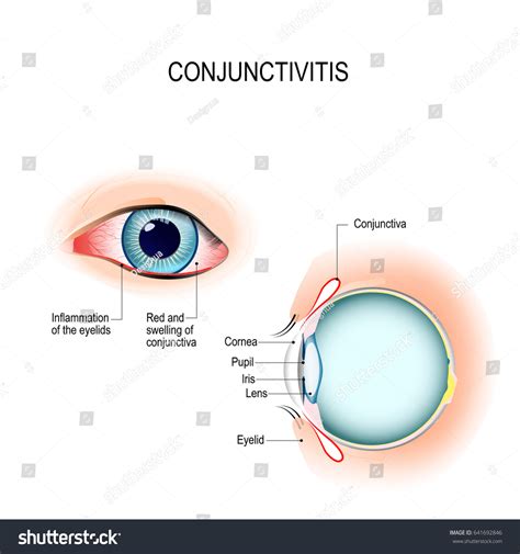 Conjunctivitis Pink Eye With Inflammation External Stock Vector