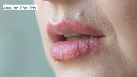 Angular Cheilitis Causes Symptoms Treatment And Prevention