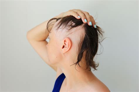 Continuing Medical Education 3 Things You Should Know About Managing Alopecia Areata