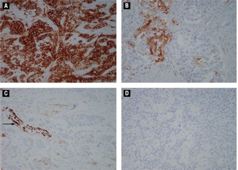 Figure 1 From High Expression Of Class Iii β Tubulin Predicts Good Response To Neoadjuvant