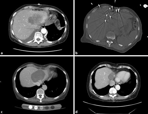 63 Year Old Female Patient With Inoperable Intrahepatic Download Scientific Diagram