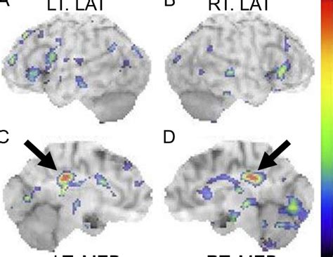 Figure2the Three Dimensional Stereotactic Surface Projections Analysis