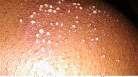 Staph Infection Vs Shingles At Juliane Michaelis Blog