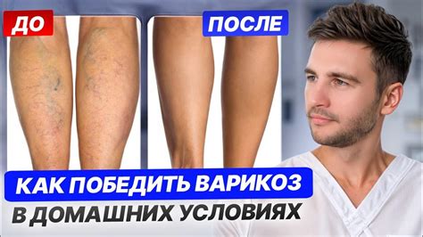 ВАРИКОЗ начнет уходить после ПЕРВОГО упражнения! / Как вылечить варикоз ...