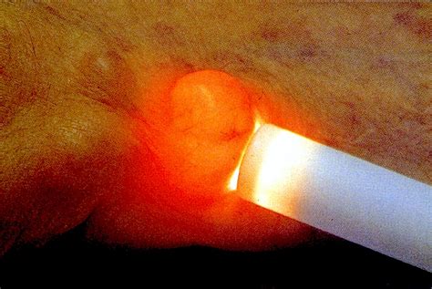 Light Transillumination Hand Surgery Resource