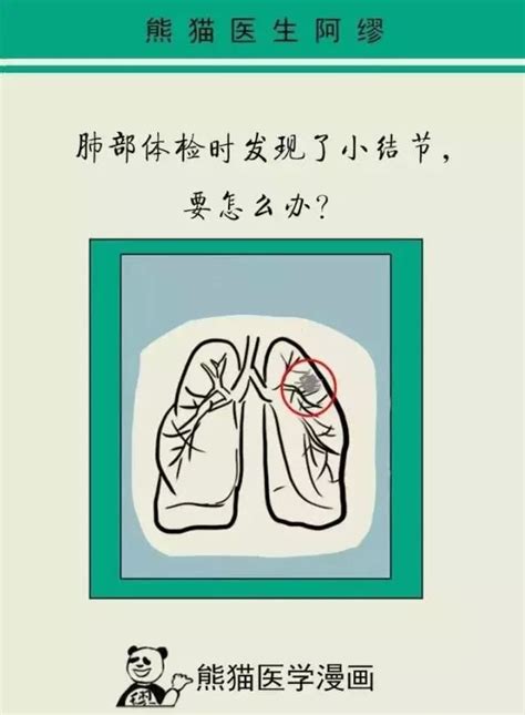 肺部小结节，离肺癌有多远？