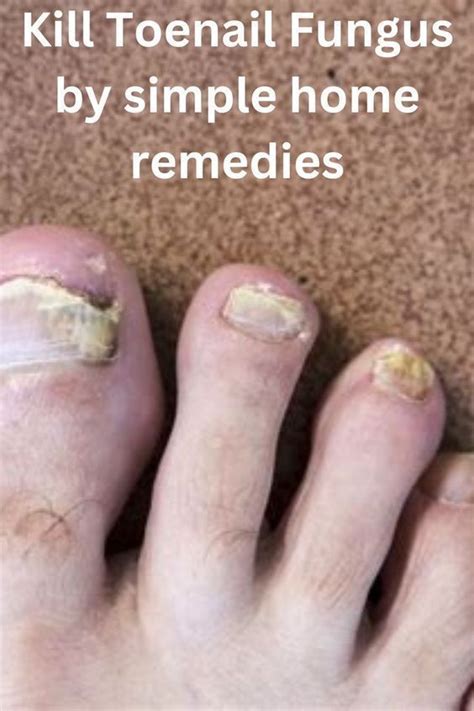 Best Natural Remedy To Kill Nail And Toenail Fungus Artofit