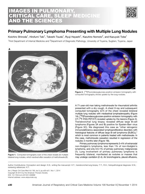 Pdf Primary Pulmonary Lymphoma Presenting With Multiple Lung Nodules