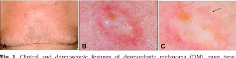 Spindle Cell Melanoma Semantic Scholar