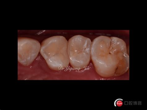 二类洞的树脂充填 牙医 西贝的博客 KQ88口腔博客