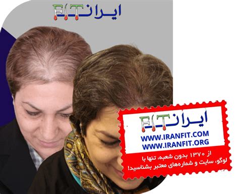 کاشت مو بانوان بدون تراشیدن سر و نتایج دائمی و طبیعی