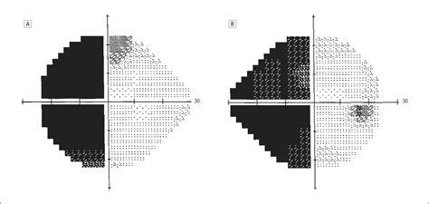 Transient Homonymous Hemianopia And Positive Visual Phenomena In