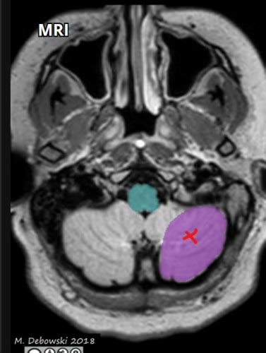 Radiology Pls Brain Flashcards Quizlet