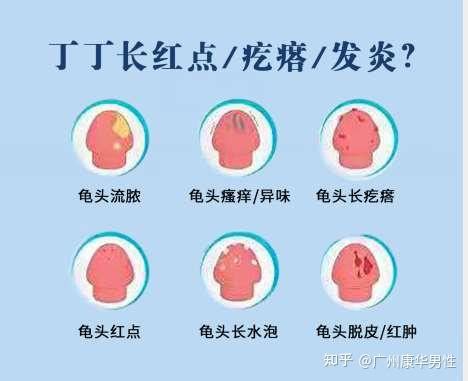 龟头上长有红点是怎么回事 番禺男科科普 知乎
