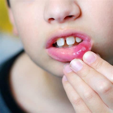 What Is Aphthous Stomatitis