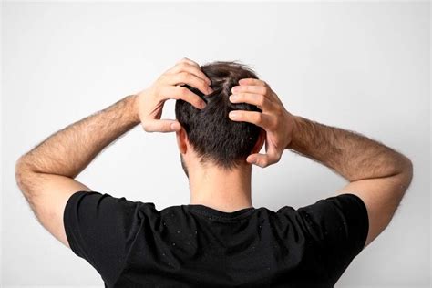 Treating Hair Loss In Patients With Autoimmune Diseases
