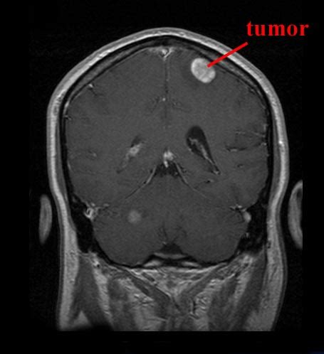 Tumor Brain Tumor Mri