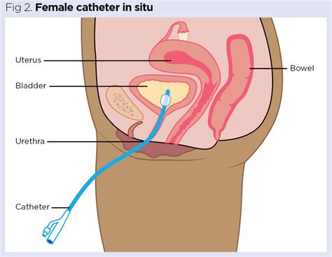 Indwelling Bowel Catheter