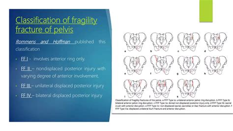 Pelvis Fracture Dislocation Ppt