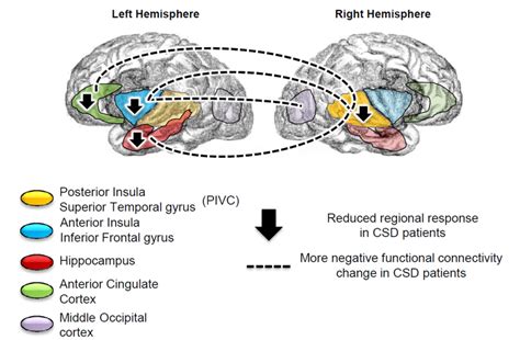 Vestibular Cortex