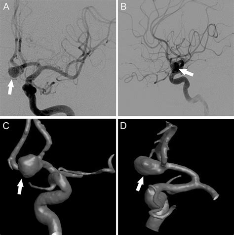 The Unruptured Intracranial Aneurysm Treatment Score Neurology