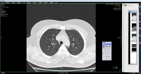 医学影像pacs系统源码 三维重建基本后处理方法的介绍和说明vtk 多平面重建mpr及三维切片显示 Csdn博客