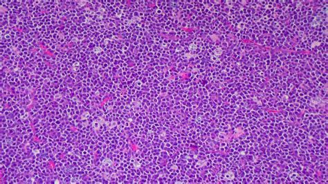 Burkitt Lymphoma Causes Symptoms Investigations And Treatment