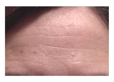 Neuromodulators Youthfx Feel A New Beauty Experience