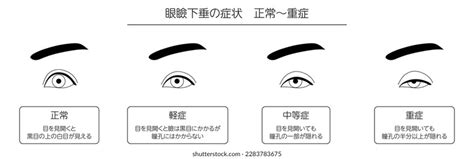 Medical Illustration Ptosis Symptoms Normal Severe Stock Vector