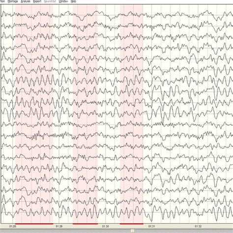 Selected Section Of Eeg Signals Without Noise And Artifacts In Adhd Case Download Scientific