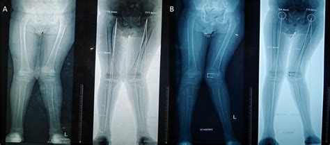 Standing X Rays Of Bilateral Tibia Femora And Pelvic Bones AP View Download Scientific