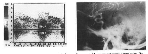 Figure 1 From Transorbital Doppler Diagnosis Of Intracranial Arterial Stenosis Semantic Scholar