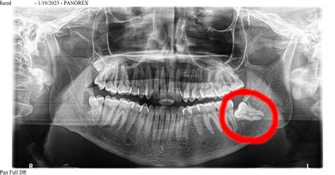 393 Best R Tmj Images On Pholder Really Really Swollen And Painful Jaw