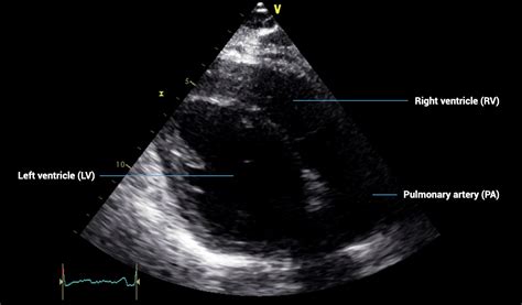 Echo Basics Parasternal Views • Litfl • Radiology Library